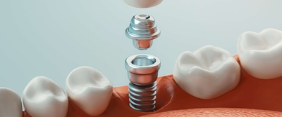 Teeth Cleaning in Monument | Woodmoor Family Dentistry